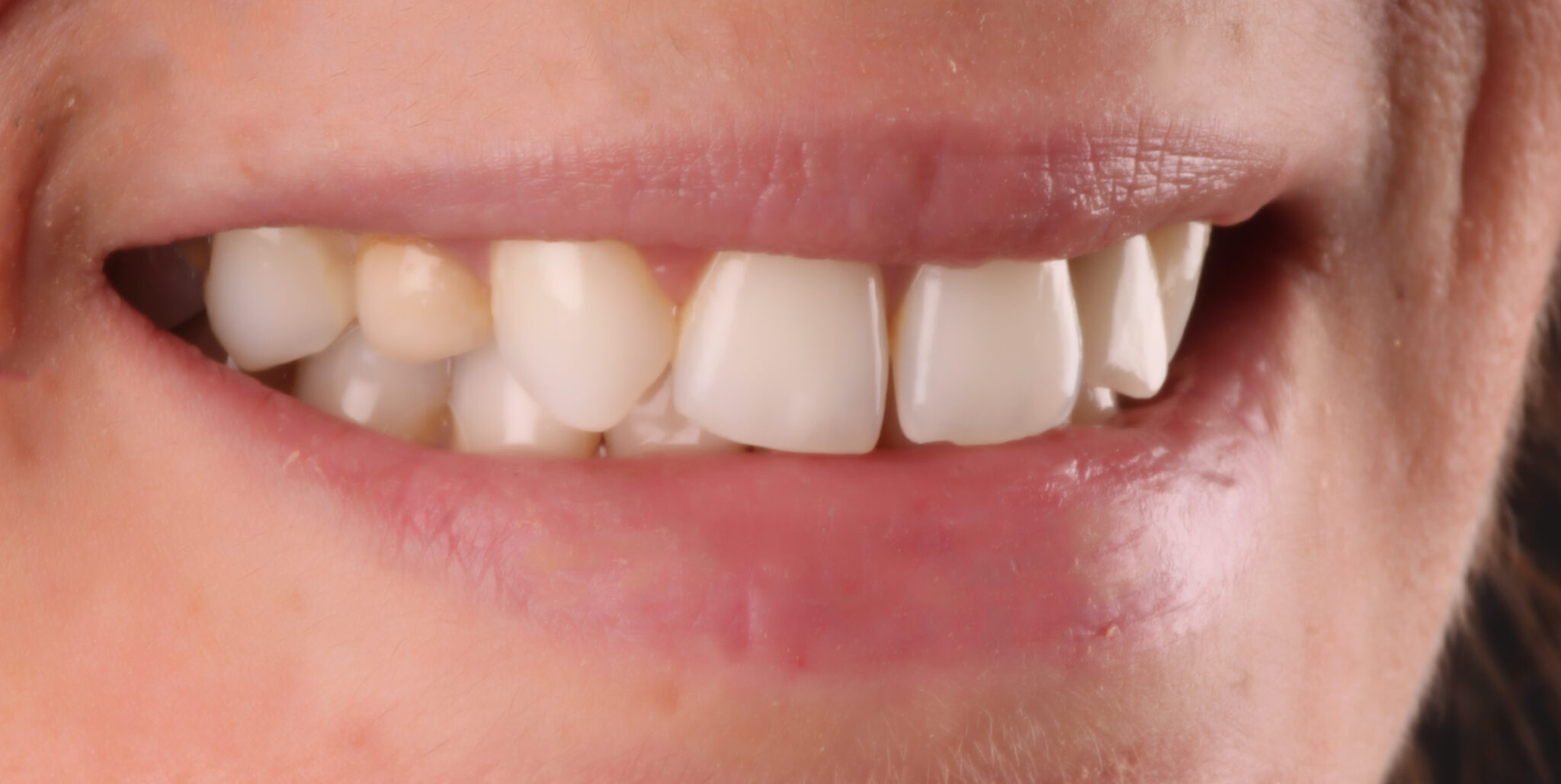 My Smile Makeover With A Great Cosmetic Dentist In Austin ~ The Autism Cafe